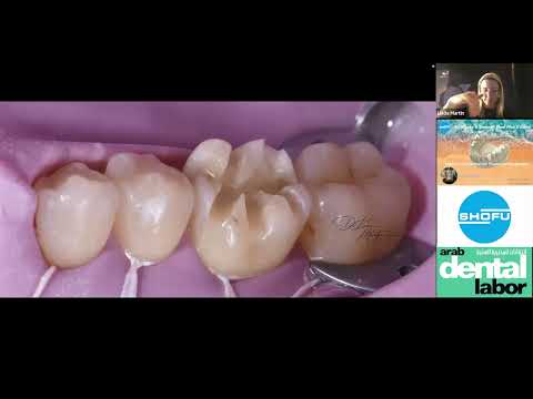 Indirect Rehabilitation Posterior Restorations . Dr Linda Martin