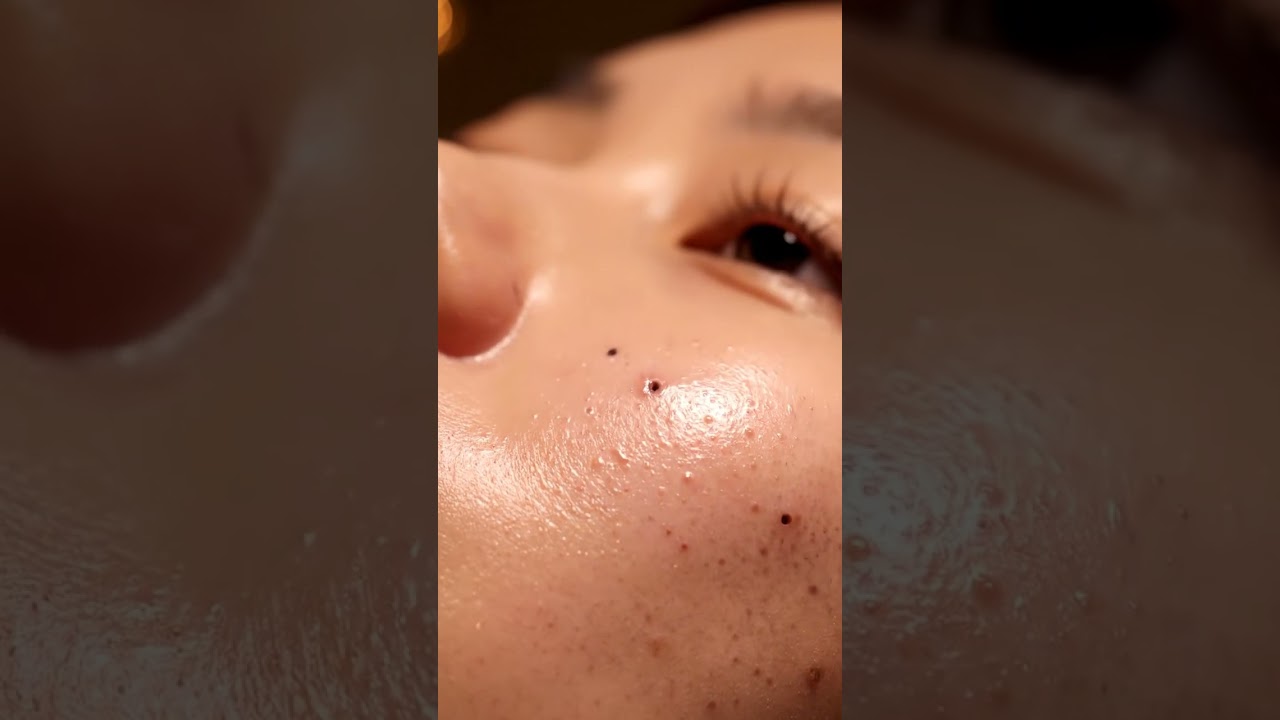“Deep Pore Vacuum Cleaning ASMR | Intense Blackhead Suction Sounds”