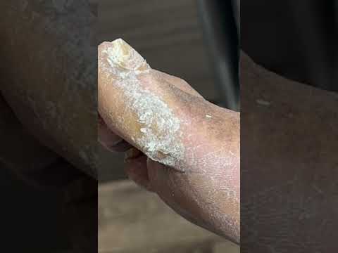 Calluses #feet #podiatry #footcare #callus #callusremoval