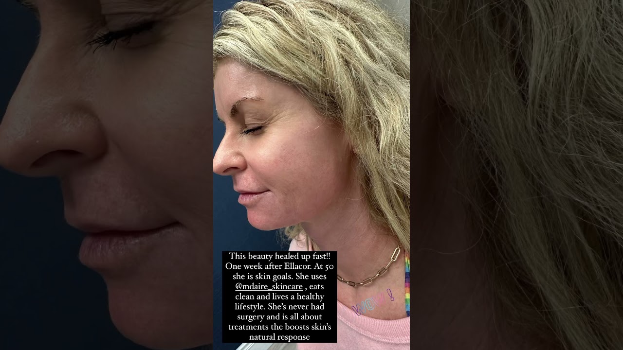 What Ellacor looks like 1 week later. Before and afters to follow #ellacor #over50 #skincare