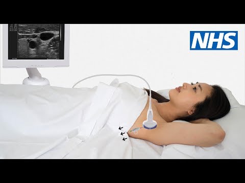 What to expect lymph node biopsy – What to… video suggestions