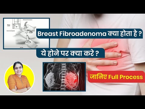 Breast Fibroadenoma in Hindi, Causes, Causes, Symptoms, Diagnosis, Breast Lumps, Treatment in India