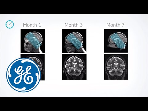 AIRx™: Intelligent MR slice prescription | GE Healthcare
