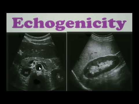 Echogenicity (Ultrasound) #ultrasoundecgogenicity #sonology