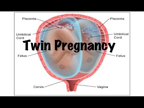 Quick OBGYN: Twin pregnancy - Whats Dizygotic & monozygotic twins
