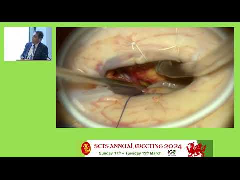 Marco Di Eusanio - Trans axillary direct view MVR