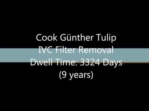 IVC Filter Removal After 9 Years Dwell Time