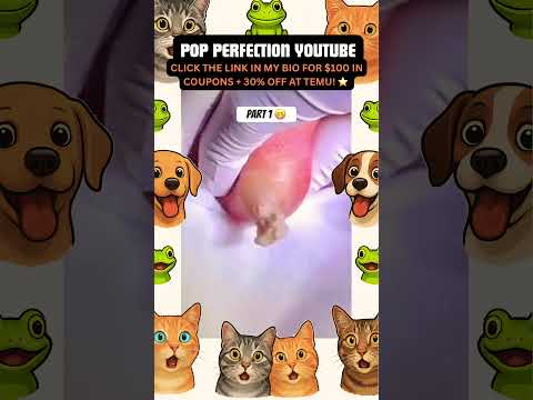 Wow! #pimple #pimplepopping #pimples #shortsfeed #shortvideo #shorts #short #youtubeshorts #youtube