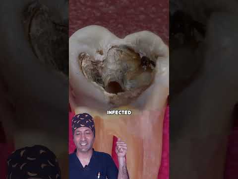 Amazing Dentist Explains Root Canal #satisfying