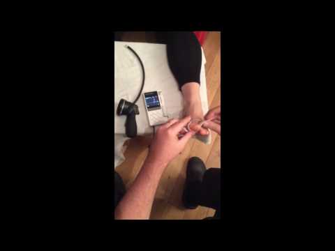 Toe systolic pressure made easy - taken with a sphyg cuff and an 8mhz Doppler