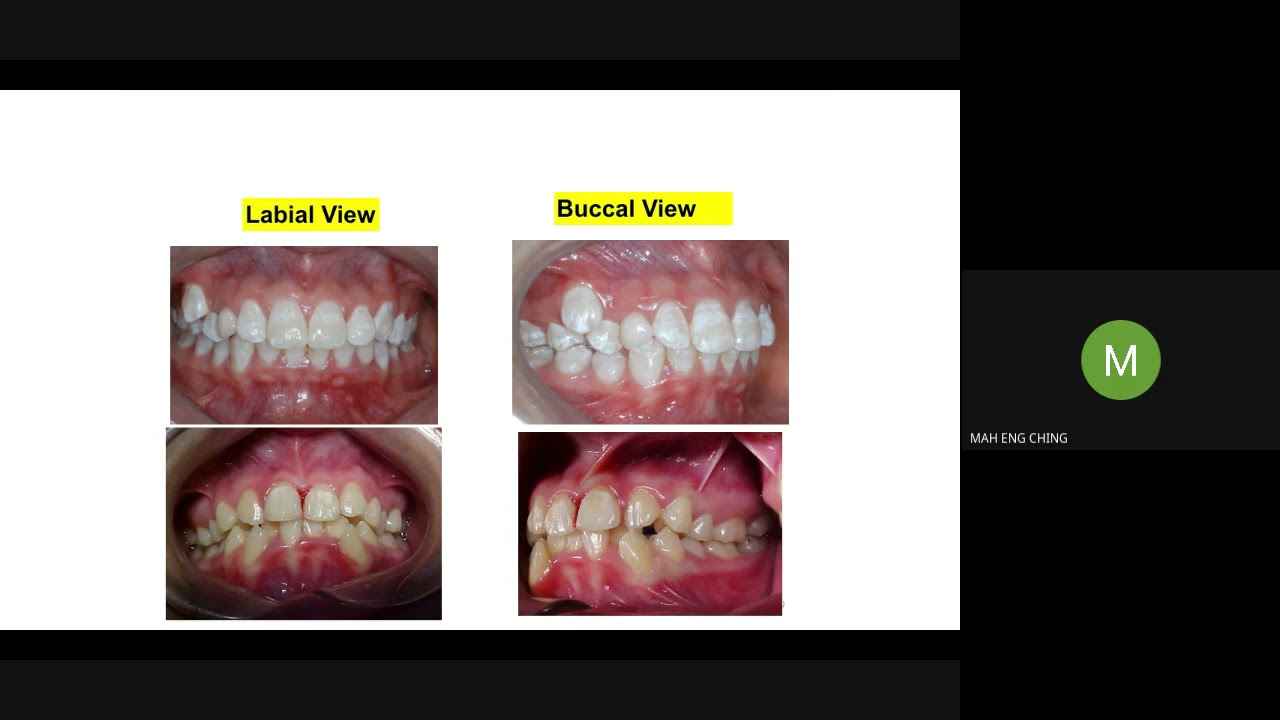 Class 1 malocclusion
