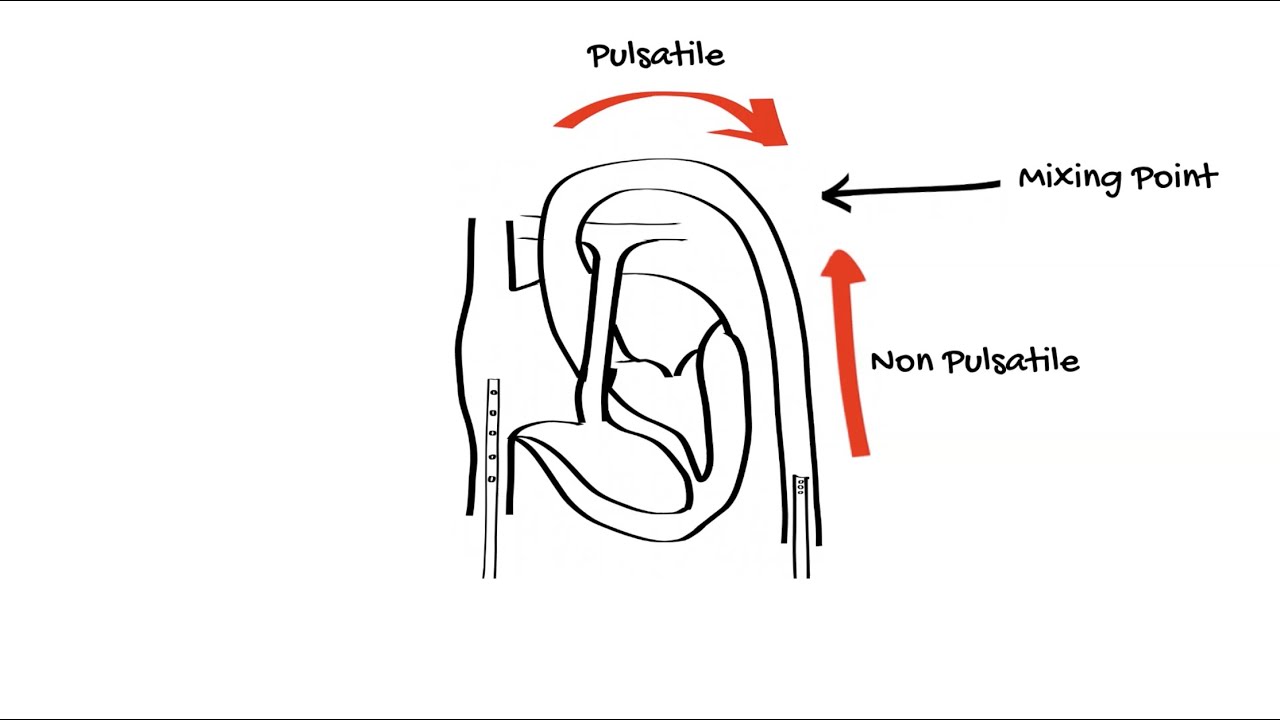 Introduction to ECMO Part 3 - V-A ECMO