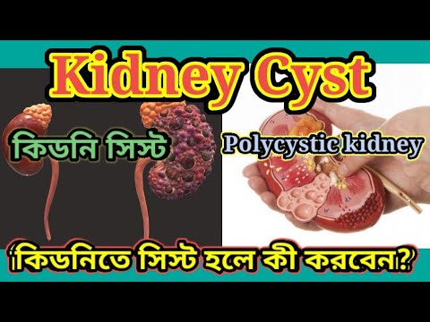 What is kidney cyst || কিডনি সিস্ট || #Polycystickidney