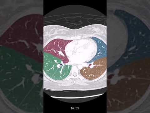 CT CHEST labeled |Images#radiology #medical #imaging #ctscan #heart