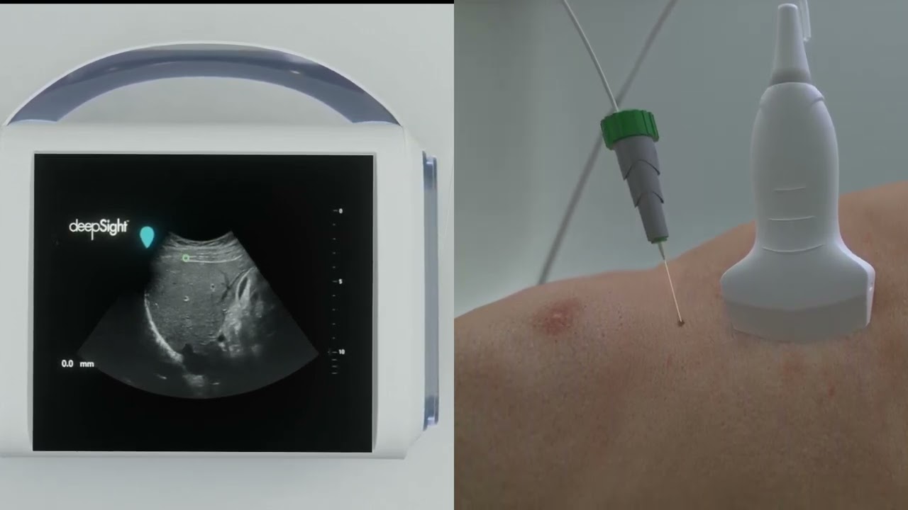 NeedleVue™ technology overcoming limitations and democratizing ultrasound guided procedures