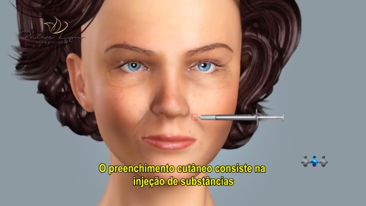 Preenchimento facial com ácido hialurônico em Vitória ES. Veja como funciona!