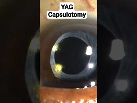 YAG Capsulotomy