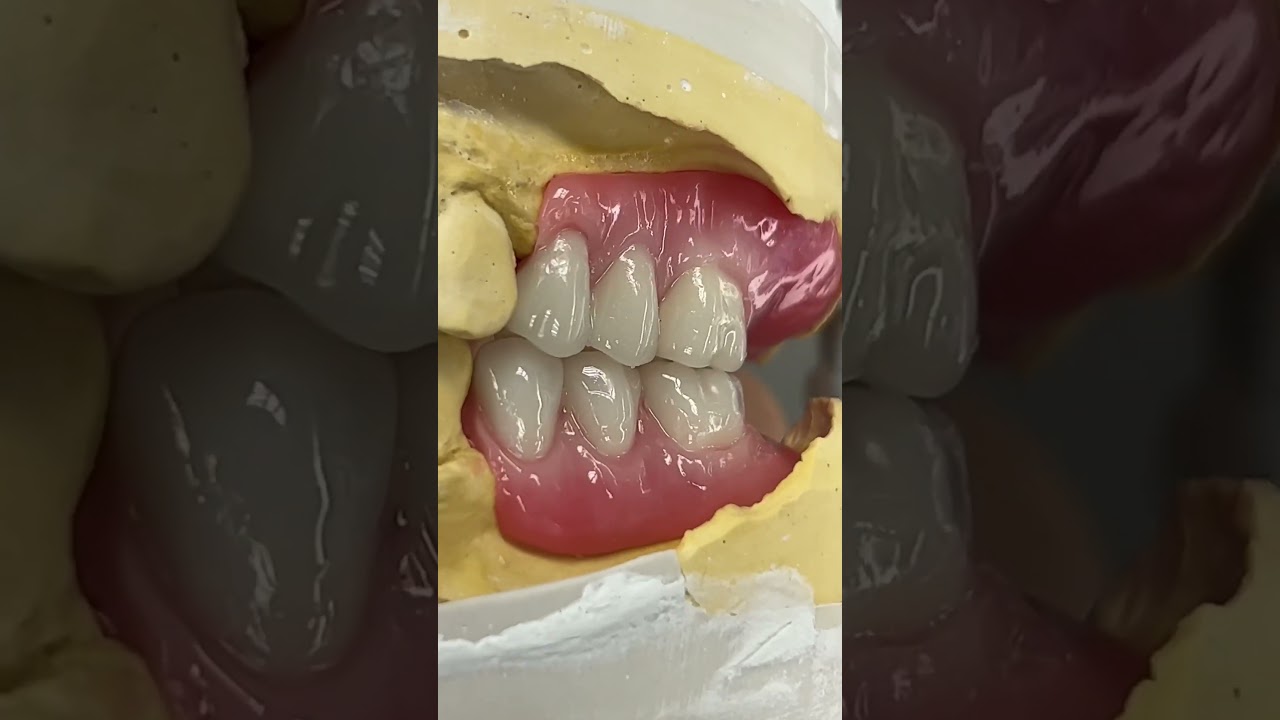 Partial Wax Try-In