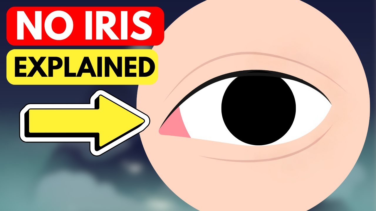 Born Without an Iris? Understanding Aniridia
