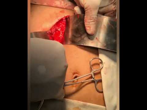 Open ureterolithotomy by Gibson Incision for lower ureteric stone
