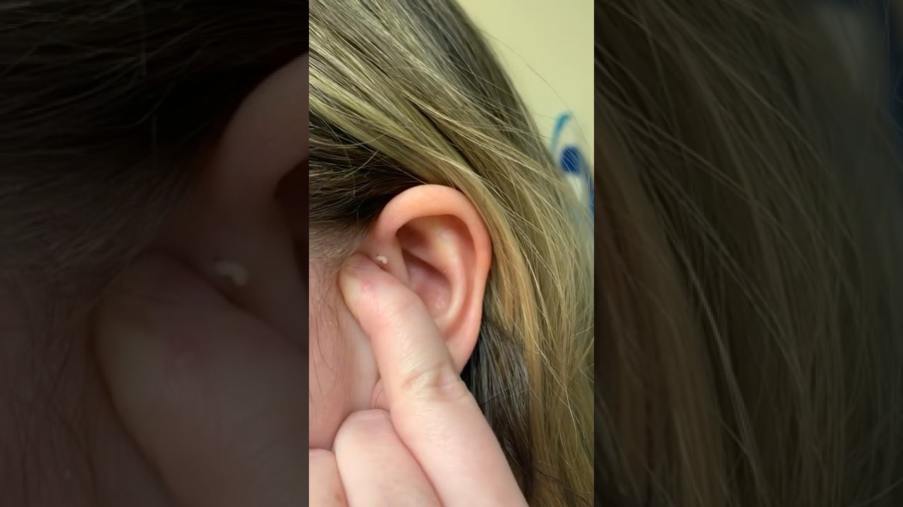 Ear pit ear sinus preauricular pit