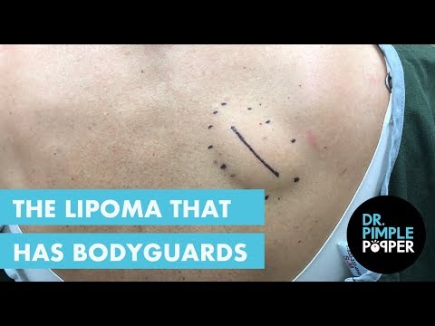 Dr. Pimple Popper Pops 'Worms' From Back Lipoma In New Instagram Video