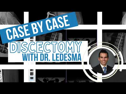 What You Should Know About a Discectomy?