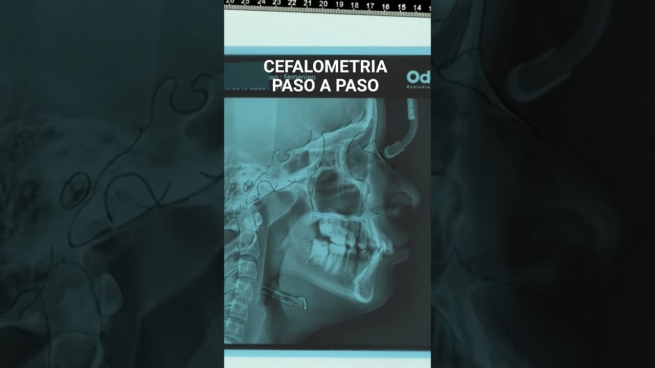 Ricketts cephalometry step by step #anatomy #dentistry #orthodontics
