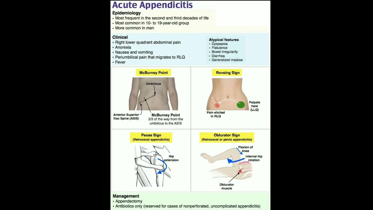 Acute Appendicitis Four signs McCBurney's Point Rovsings sign Psoas sign Obturator sign #doctor