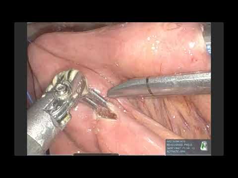 ROBOTIC BILIARY RECONSTRUCTION UTILIZING HEPP COUINAUD TECHNIQUE WITH ROUX EN Y HEPATICOJEJUNOSTOMY