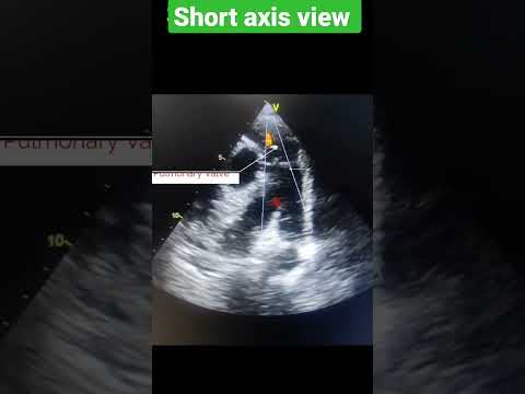 Pulmonary artery in Echocardiography #shorts #youtubeshorts