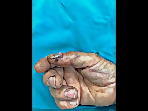 A trapped Thumb With Distal Phalanx Fracture and Nail Bed Laceration.