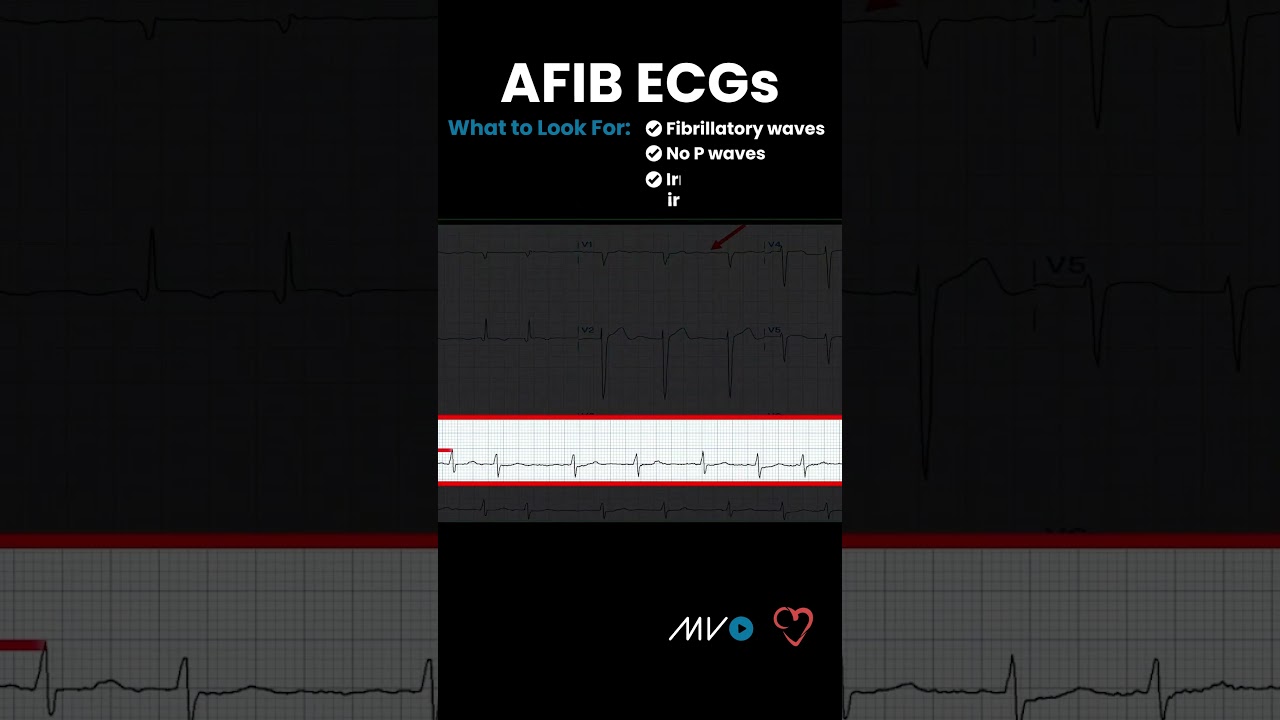 What to Look for in an AFib ECG