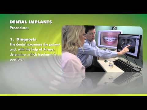 Straumann Implants