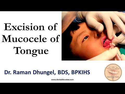 Excision of a Mucocele in Tongue - Dr. Raman Dhungel