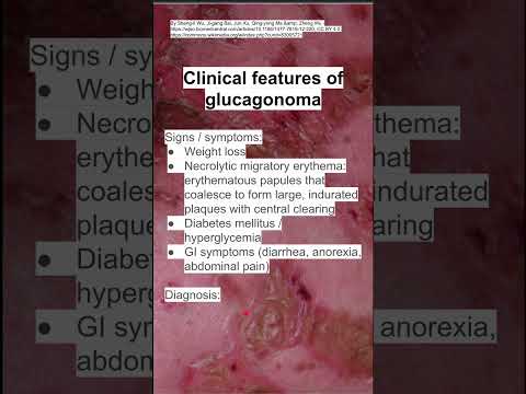 Clinical features of glucagonoma