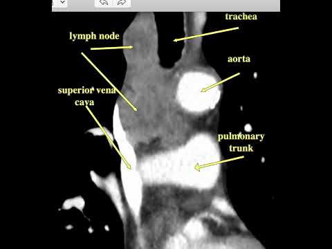 mediastinal-adenopathy