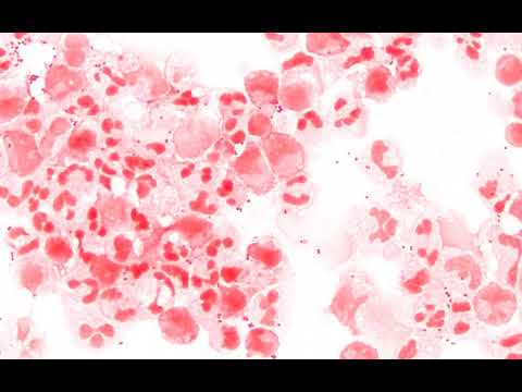 Conversation - Meningococcal Meningitis