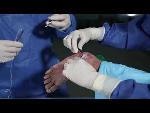 STRAVIX PL with Ulcer Repair