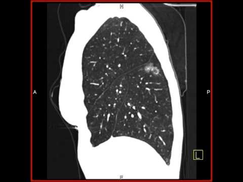 Lung Anatomy: Bronchoalveolar Cell Carcinoma (1 of 3)