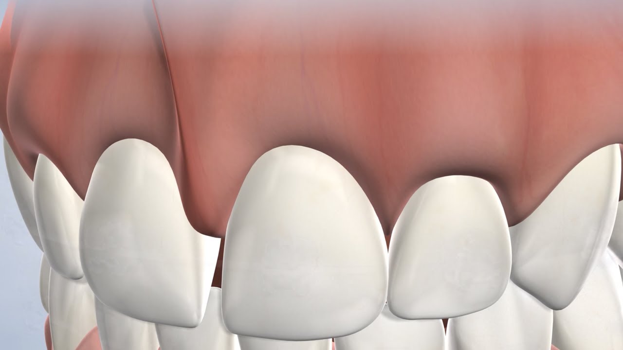 Frenectomy in Grove City, OH | Greater Columbus Oral Surgery & Dental Implants
