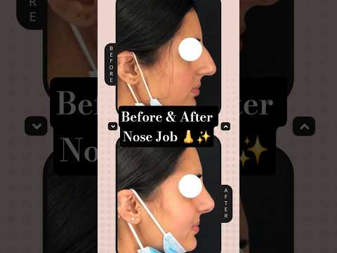 Stunning Nose Job Before and After Results 👃✨ See the Transformation