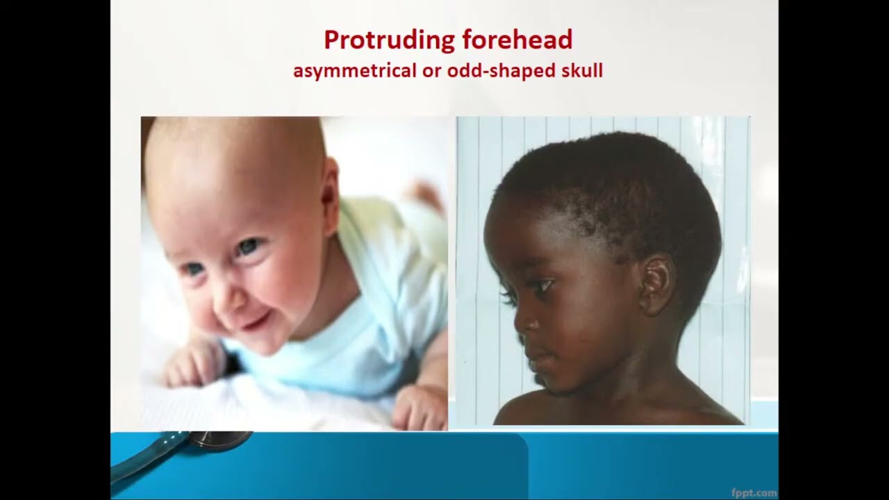 Understanding Rickets: Causes, Symptoms, and Treatment | Galaxy.ai