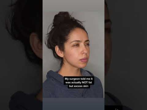 Necklift + Chin Implant BEFORE & AFTER 🔥 #plasticsurgery #glowup #beforeandafter