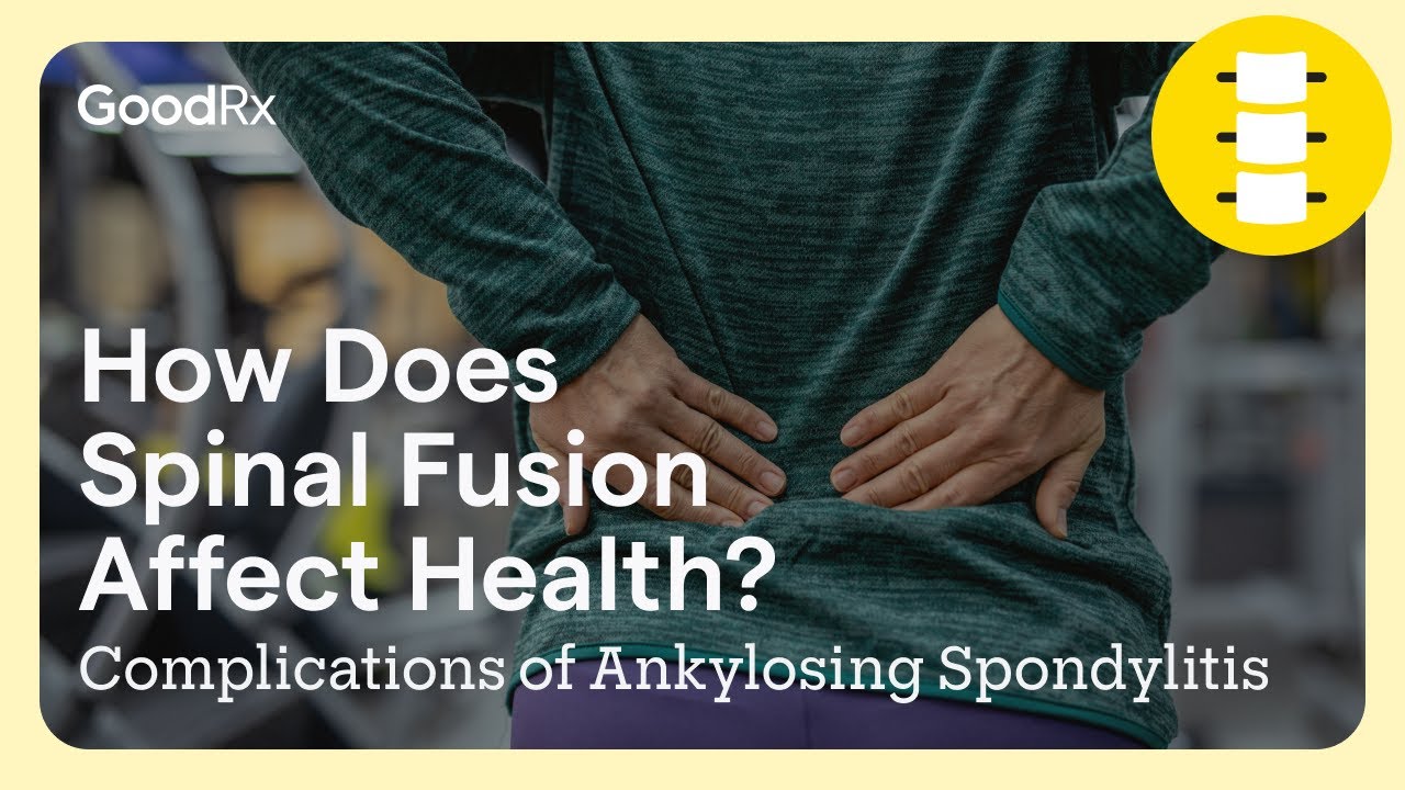 What Are Health Effects of Spinal Fusion From Ankylosing Spondylitis? | GoodRx
