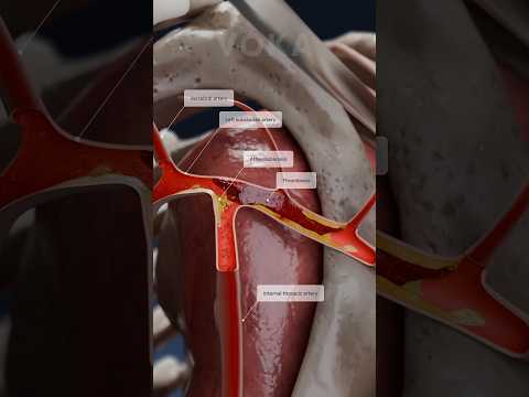 Thrombosis 3D animation | clot formation in the subclavian artery explained in 3D with VOKA