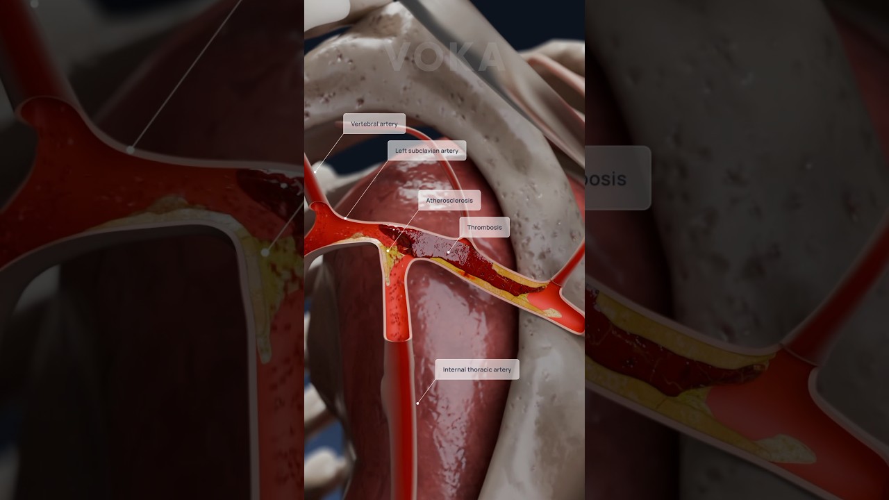 Thrombosis 3D animation | clot formation in the subclavian artery explained in 3D with VOKA
