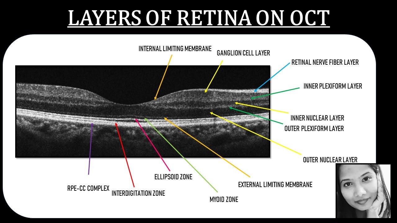 Learn How To Identify Retinal Layers on OCT | Retina | Ophthalmology