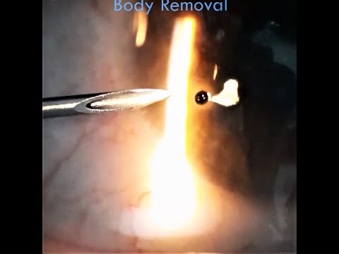 Metallic Corneal Foreign Body Removal with Needle - Patient helps with Blink!