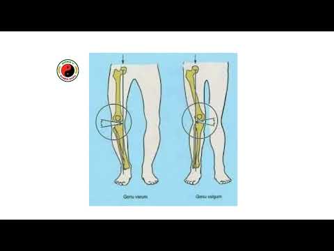Đau khớp Gối do lệch trục khớp Gối dẫn đến thoái hóa Khớp Gối